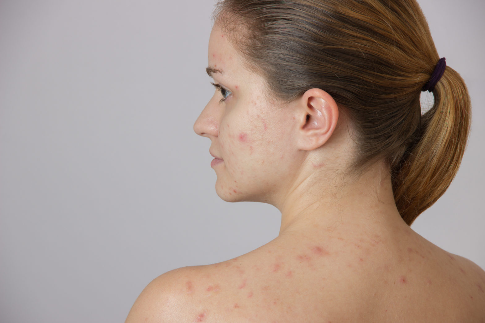 Clindamycin (Cleocin) Uses, Side Effects & Dosage - SelfDecode Drugs